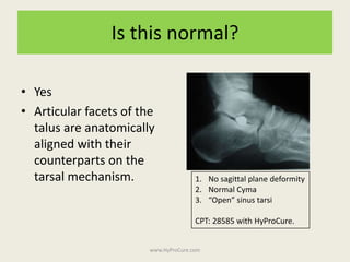 TaloTarsal Dislocation - Radiographic Evidence