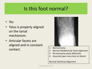 TaloTarsal Dislocation - Radiographic Evidence
