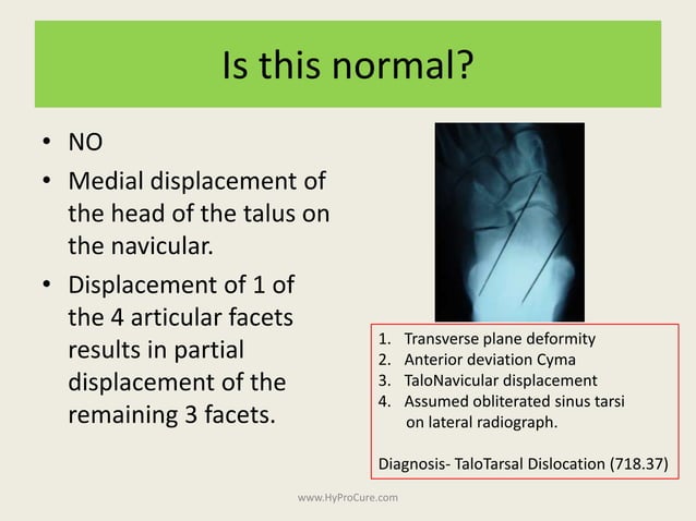 TaloTarsal Dislocation - Radiographic Evidence