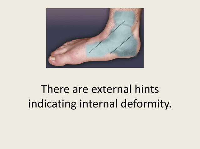 TaloTarsal Dislocation - Radiographic Evidence