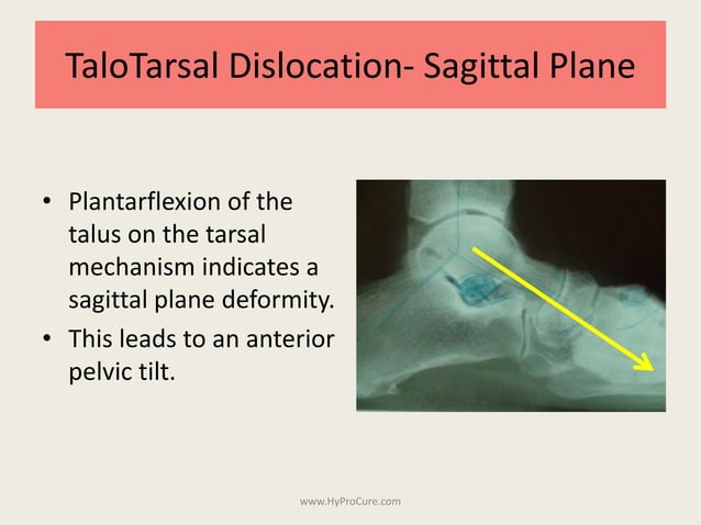 TaloTarsal Dislocation - Radiographic Evidence