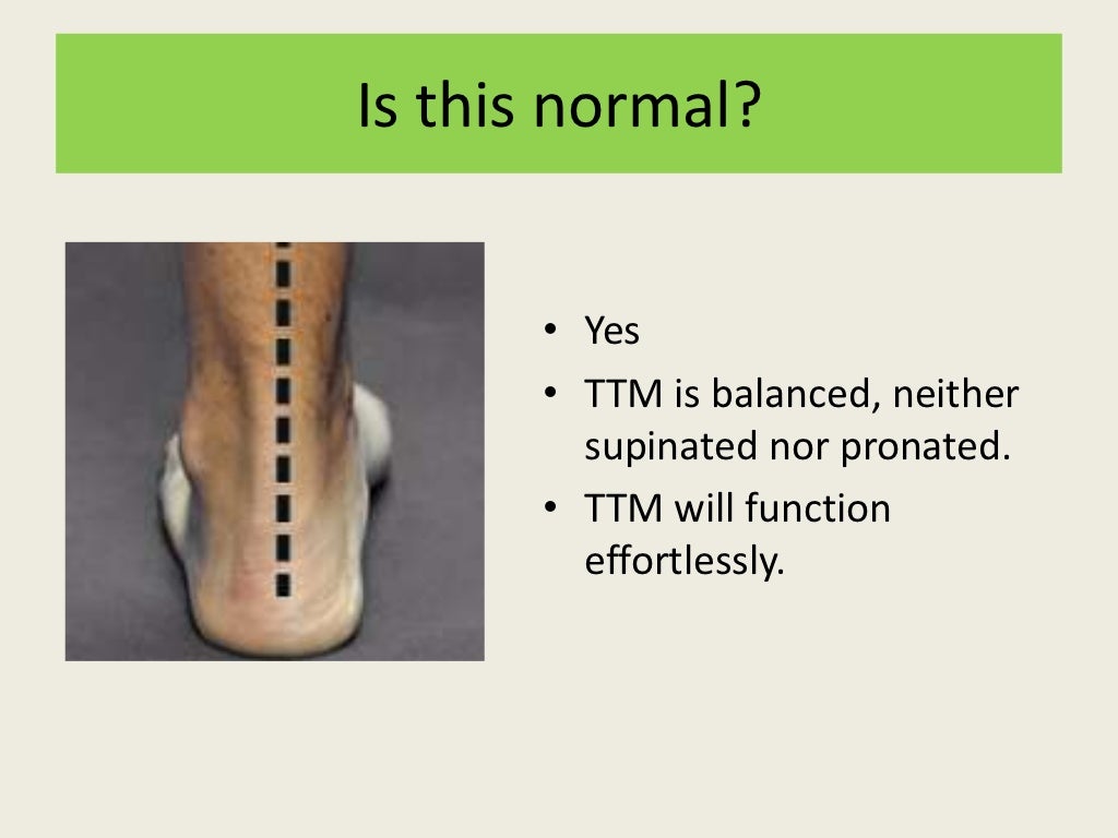 TaloTarsal Dislocation - Radiographic Evidence