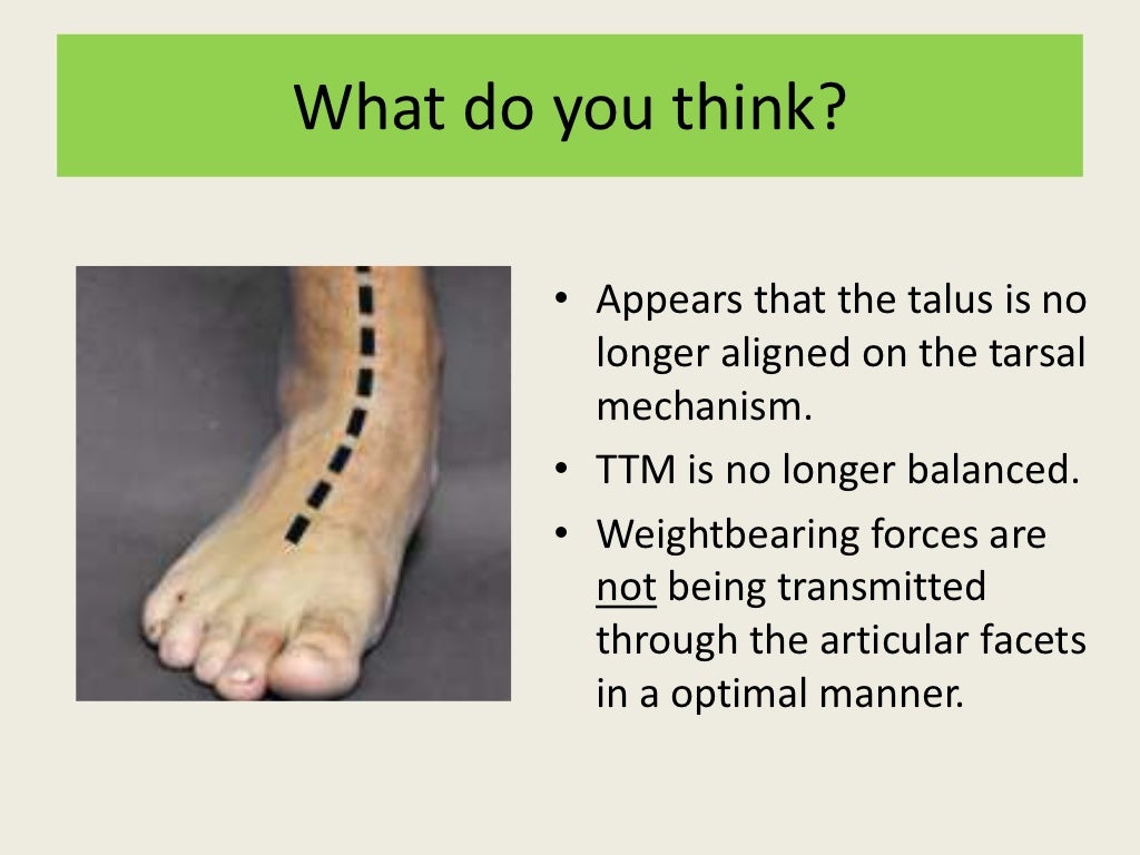 TaloTarsal Dislocation - Radiographic Evidence