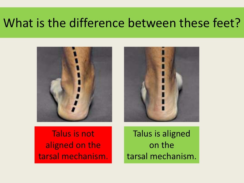 TaloTarsal Dislocation - Radiographic Evidence