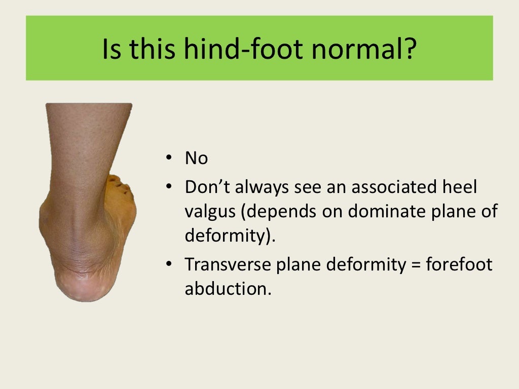TaloTarsal Dislocation - Radiographic Evidence