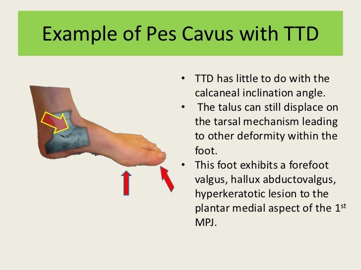 TaloTarsal Dislocation - Radiographic Evidence