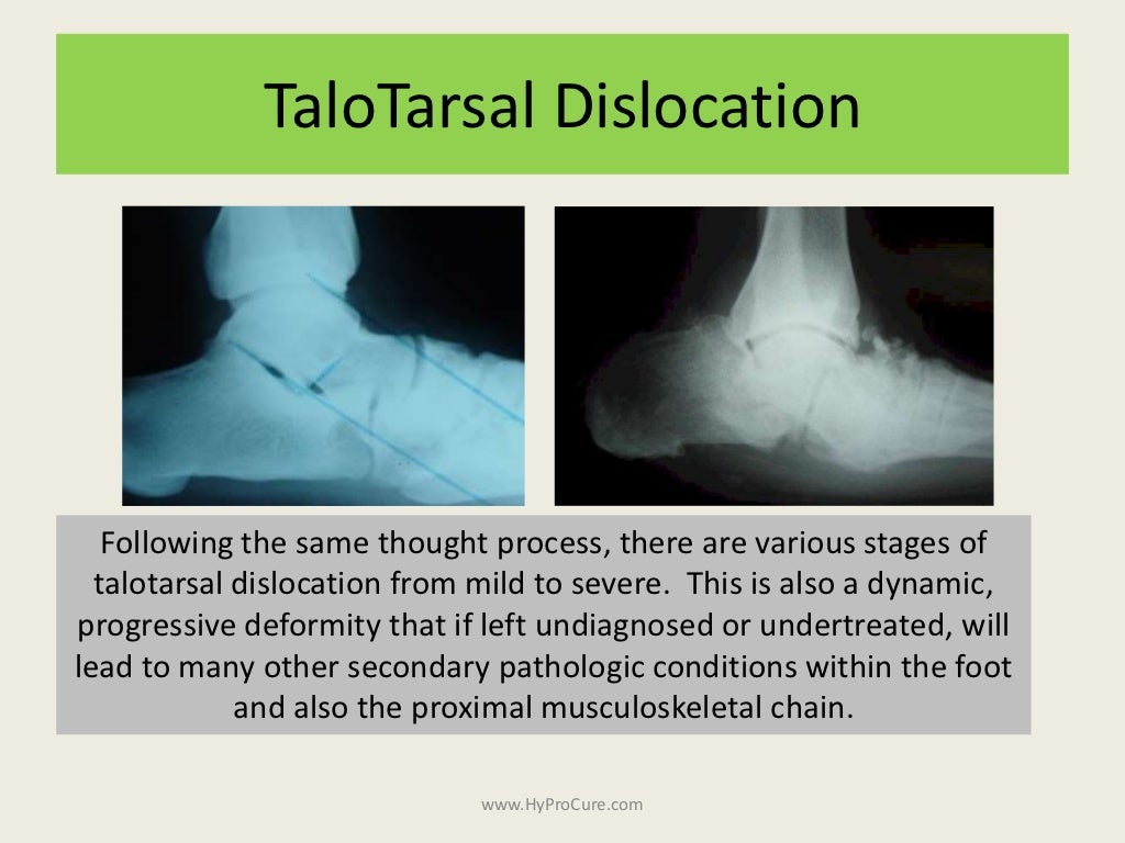 TaloTarsal Dislocation - Radiographic Evidence