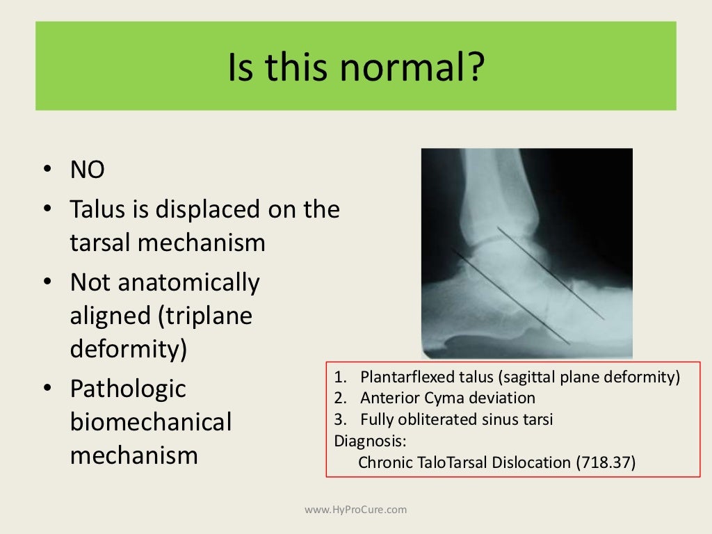 TaloTarsal Dislocation - Radiographic Evidence