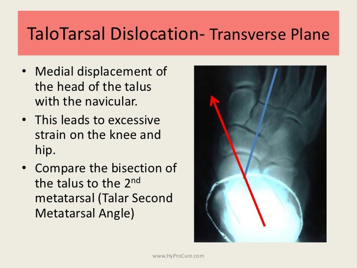 TaloTarsal Dislocation - Radiographic Evidence