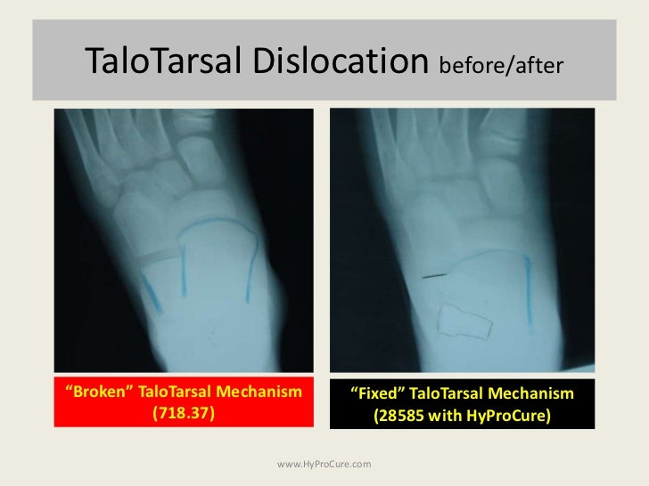 TaloTarsal Dislocation - Radiographic Evidence