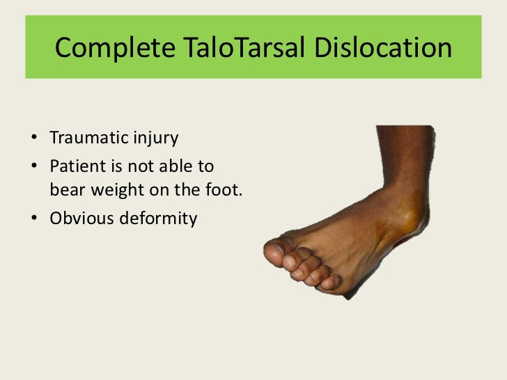 TaloTarsal Dislocation - Radiographic Evidence