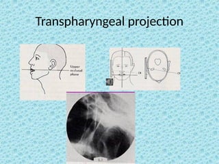 RADIOGRAPHIC EXAMINATION OF TMJ.pptx. | PPTX