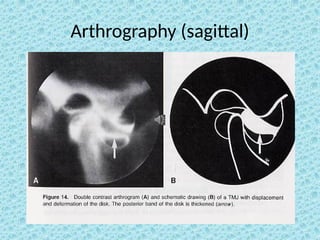 RADIOGRAPHIC EXAMINATION OF TMJ.pptx. | PPTX