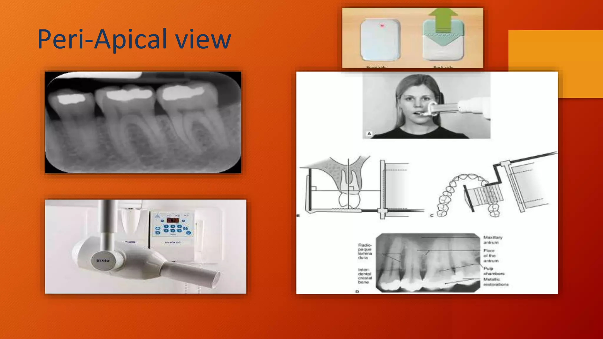 RADIOGRAPHIC EXAMINATIONS OF BONE LOSS AND PATTERN OF BONE LOSS | PPTX
