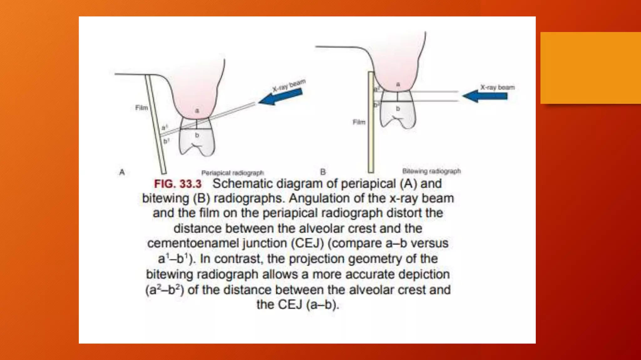 RADIOGRAPHIC EXAMINATIONS OF BONE LOSS AND PATTERN OF BONE LOSS | PPTX