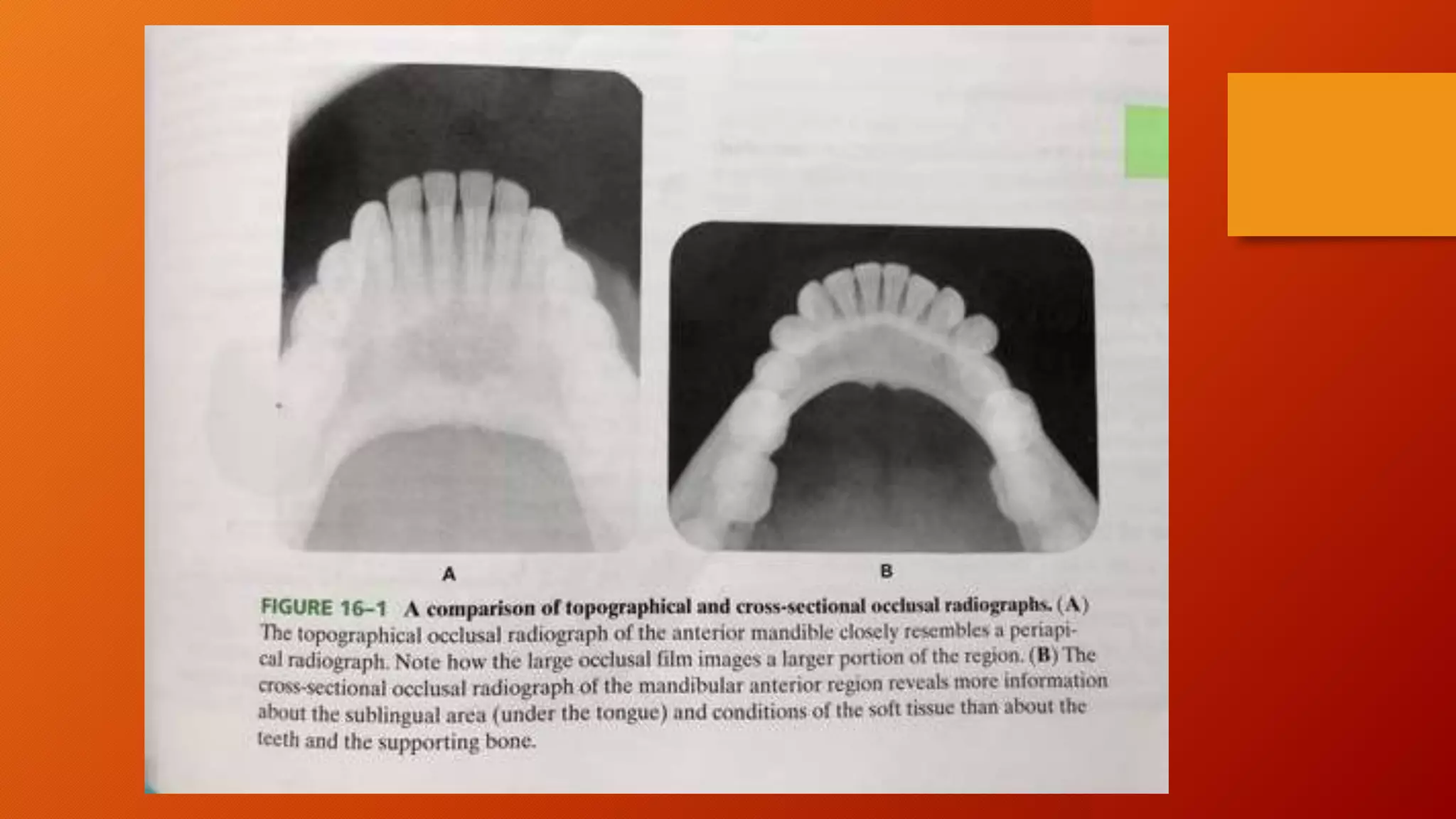 RADIOGRAPHIC EXAMINATIONS OF BONE LOSS AND PATTERN OF BONE LOSS | PPTX