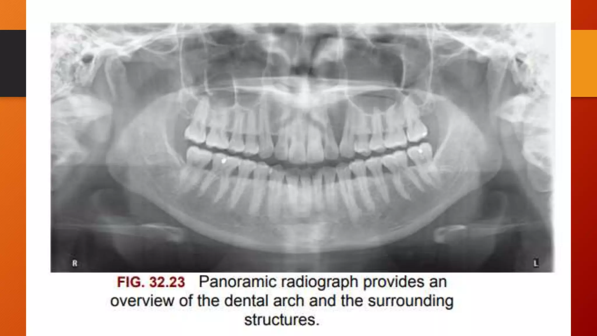 RADIOGRAPHIC EXAMINATIONS OF BONE LOSS AND PATTERN OF BONE LOSS | PPTX