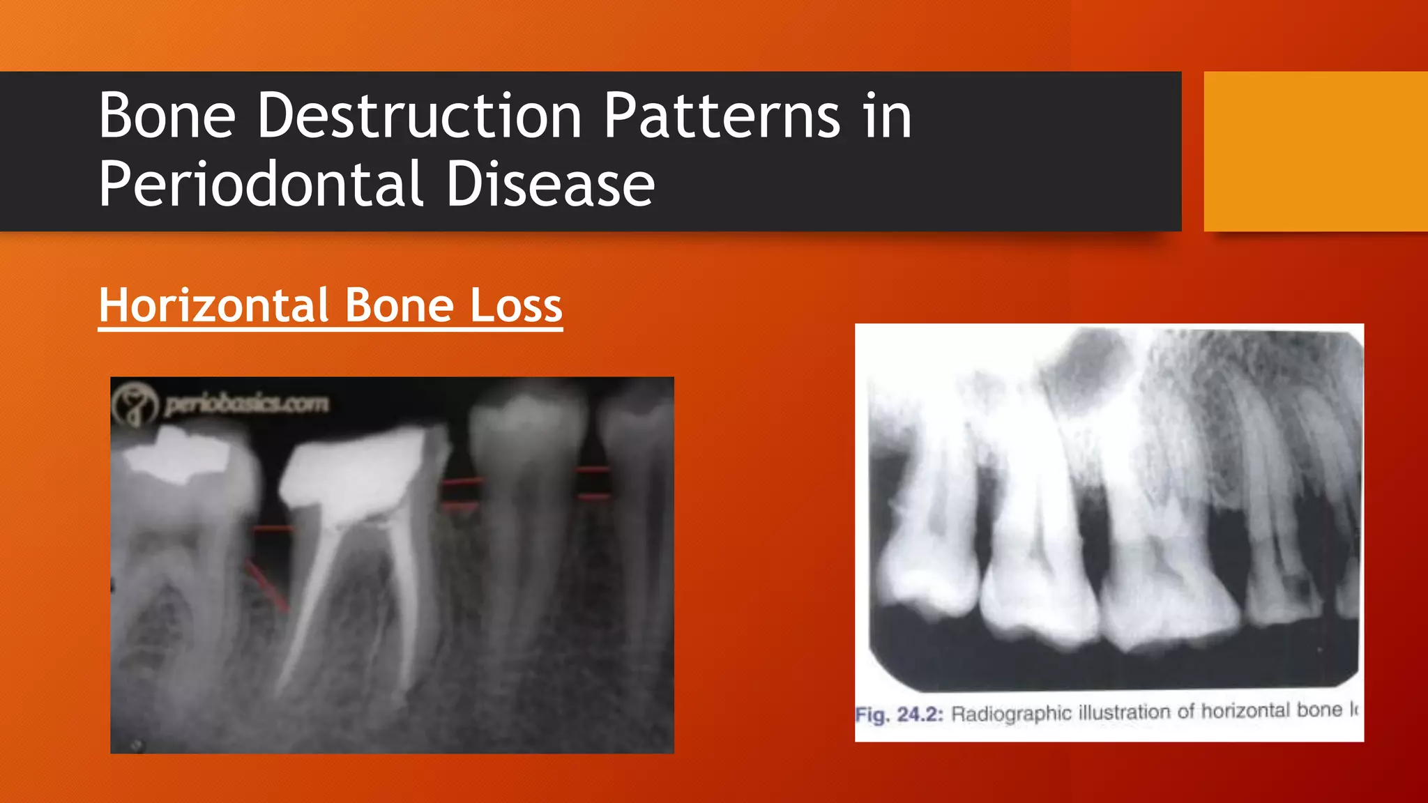 RADIOGRAPHIC EXAMINATIONS OF BONE LOSS AND PATTERN OF BONE LOSS | PPTX
