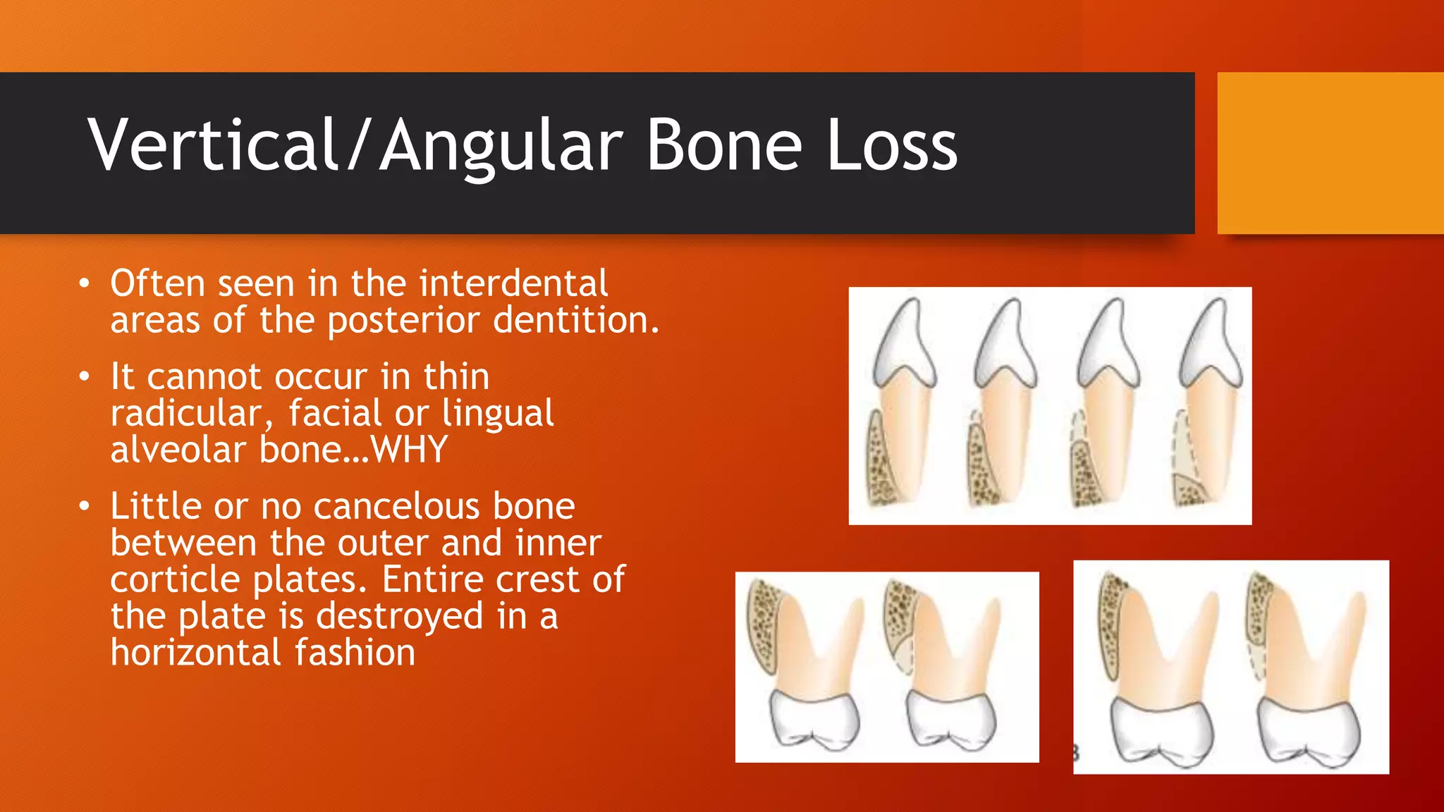 RADIOGRAPHIC EXAMINATIONS OF BONE LOSS AND PATTERN OF BONE LOSS | PPTX