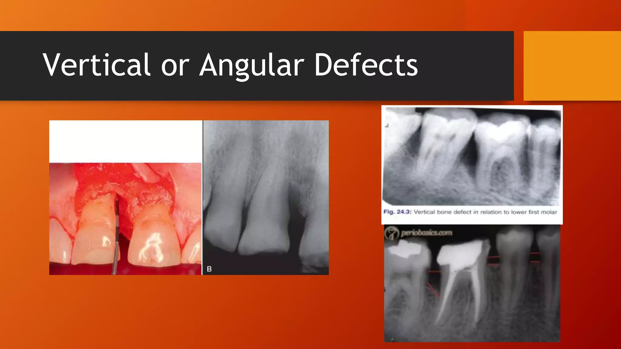 RADIOGRAPHIC EXAMINATIONS OF BONE LOSS AND PATTERN OF BONE LOSS | PPTX
