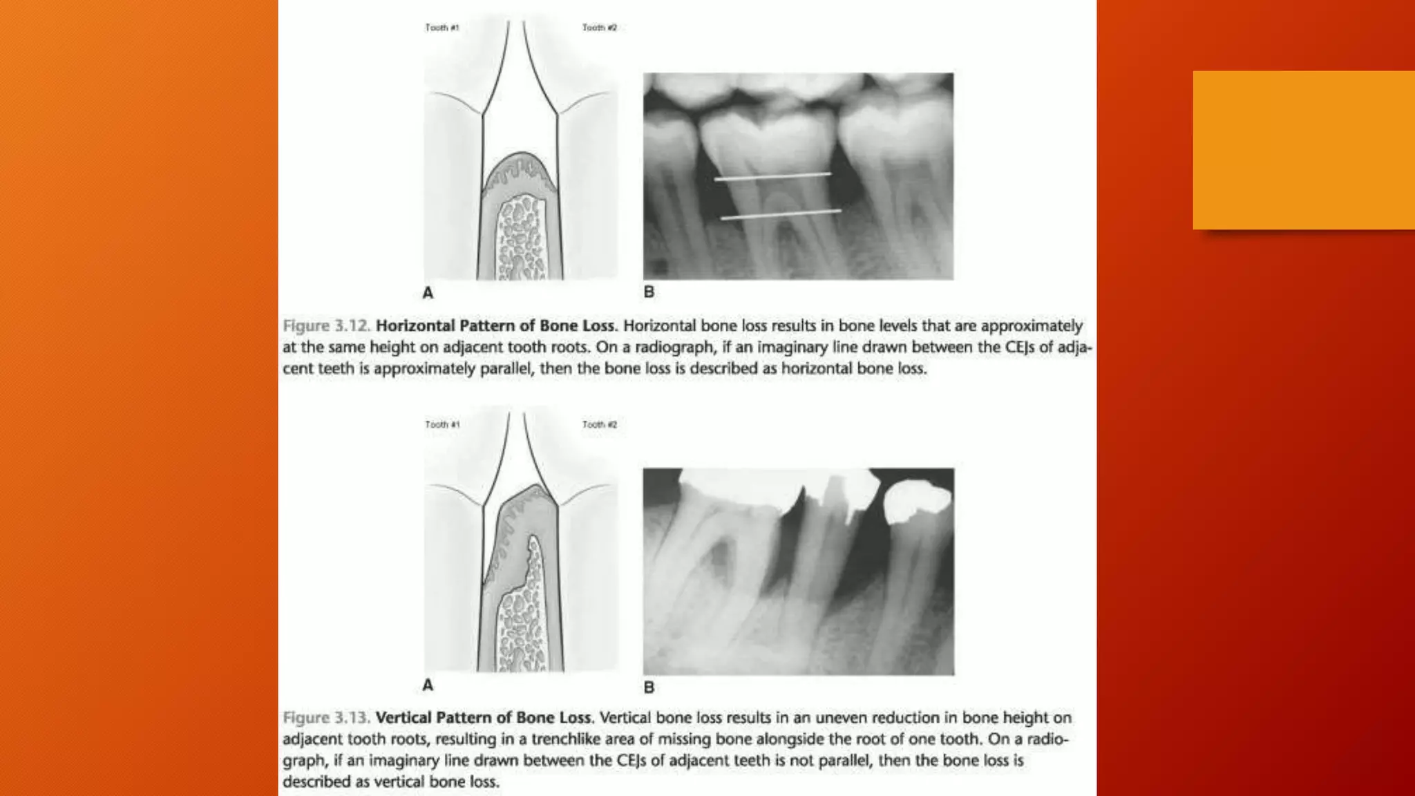 RADIOGRAPHIC EXAMINATIONS OF BONE LOSS AND PATTERN OF BONE LOSS | PPTX