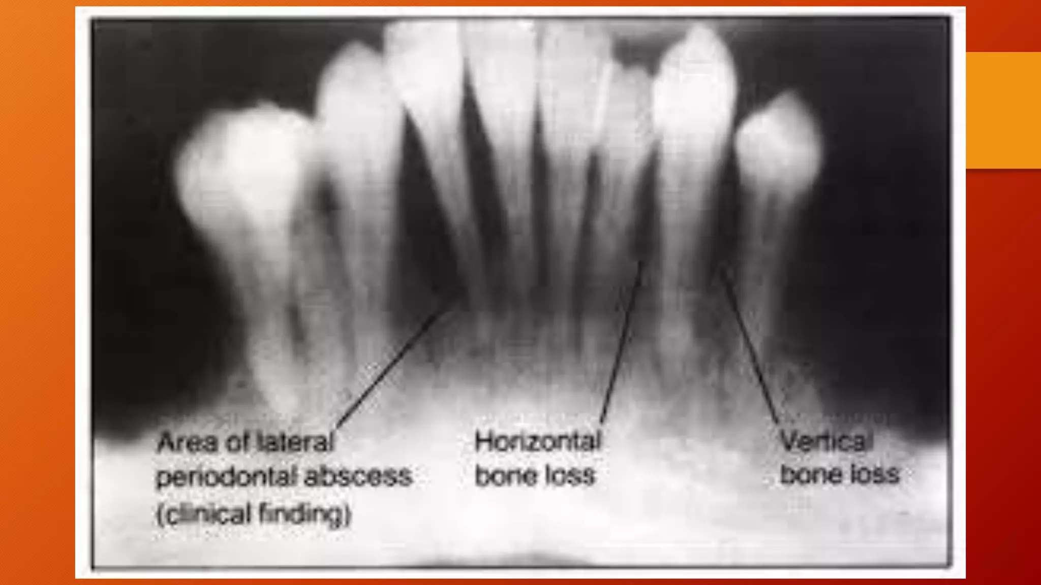 RADIOGRAPHIC EXAMINATIONS OF BONE LOSS AND PATTERN OF BONE LOSS | PPTX