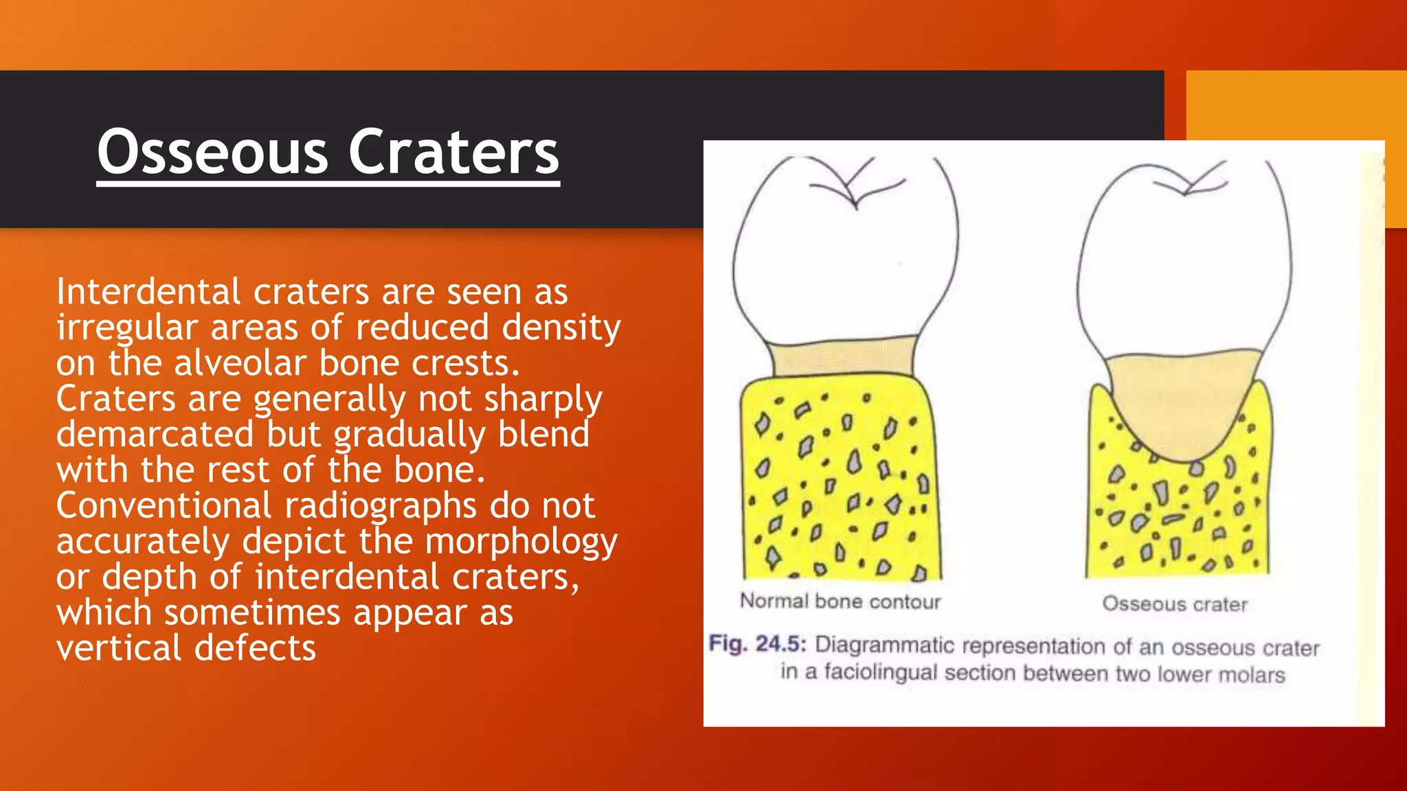 RADIOGRAPHIC EXAMINATIONS OF BONE LOSS AND PATTERN OF BONE LOSS | PPTX