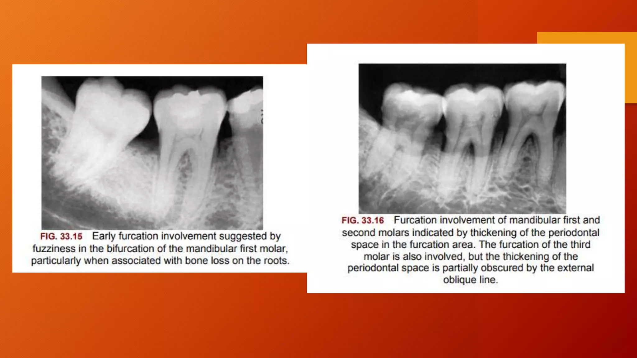 RADIOGRAPHIC EXAMINATIONS OF BONE LOSS AND PATTERN OF BONE LOSS | PPTX