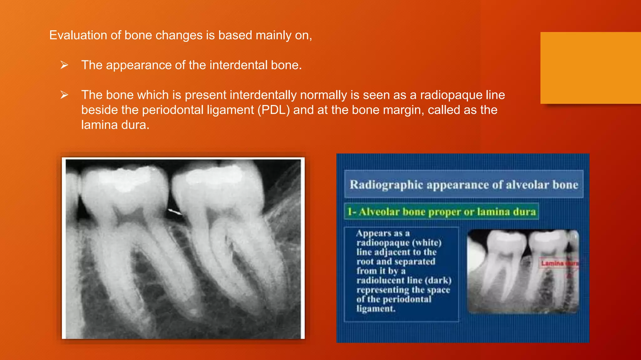 RADIOGRAPHIC EXAMINATIONS OF BONE LOSS AND PATTERN OF BONE LOSS | PPTX
