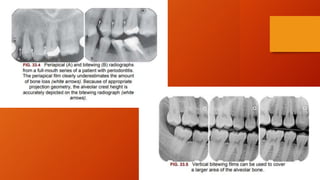 RADIOGRAPHIC EXAMINATIONS OF BONE LOSS AND PATTERN OF BONE LOSS | PPTX