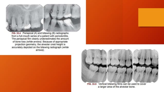 RADIOGRAPHIC EXAMINATIONS OF BONE LOSS AND PATTERN OF BONE LOSS | PPTX