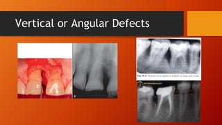 RADIOGRAPHIC EXAMINATIONS OF BONE LOSS AND PATTERN OF BONE LOSS | PPTX