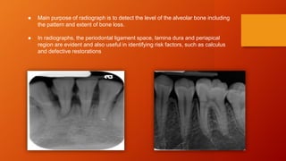 RADIOGRAPHIC EXAMINATIONS OF BONE LOSS AND PATTERN OF BONE LOSS | PPTX