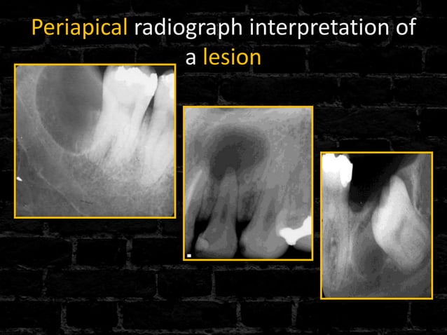 Radiographic interpretation of a lesion | PPTX | Dental Health ...