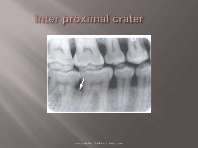 Radiographic interpretation of periodontal diseases /prosthodontic c…