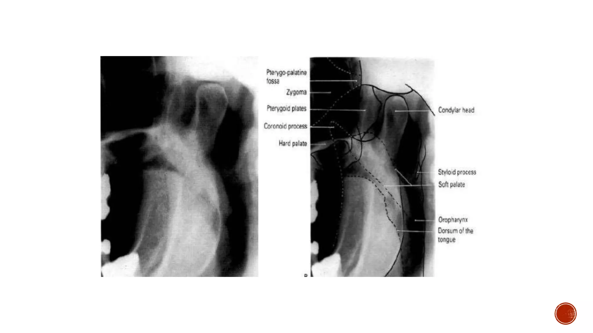 Radiographic investigations in oral and maxillofacial surgery | PPTX