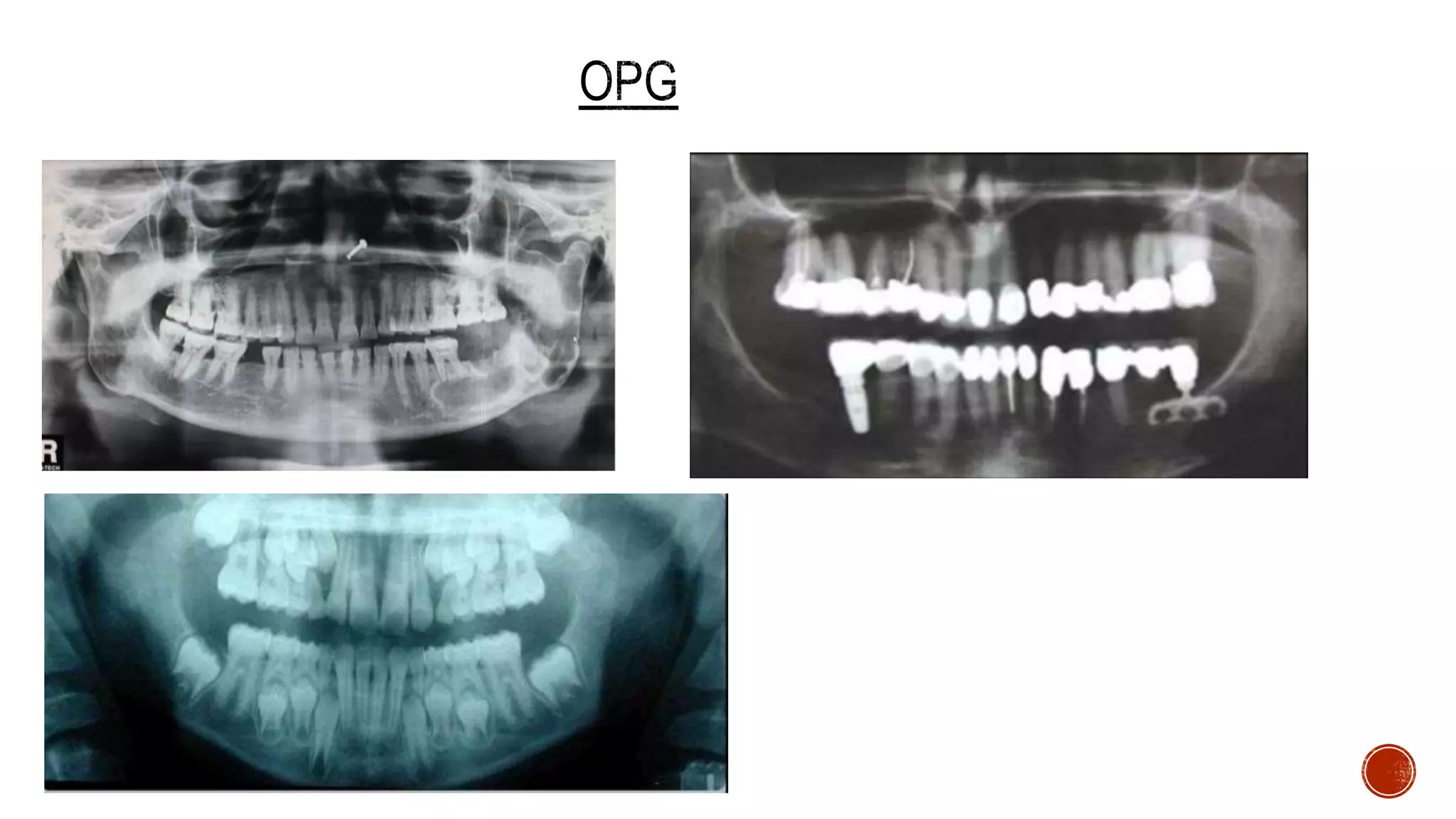 Radiographic investigations in oral and maxillofacial surgery | PPTX