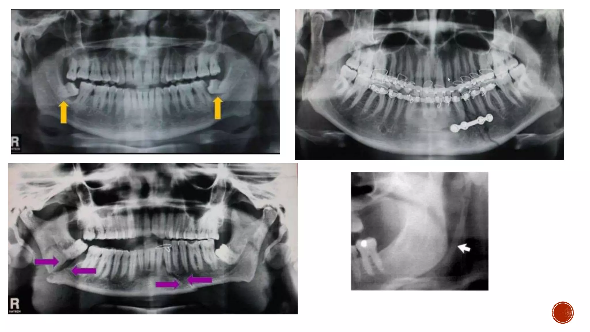 Radiographic investigations in oral and maxillofacial surgery | PPTX
