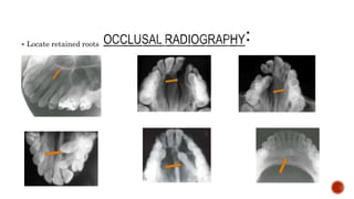 Radiographic investigations in oral and maxillofacial surgery | PPTX