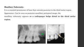 radiographic landmarks of maxilla and mandible | PPTX
