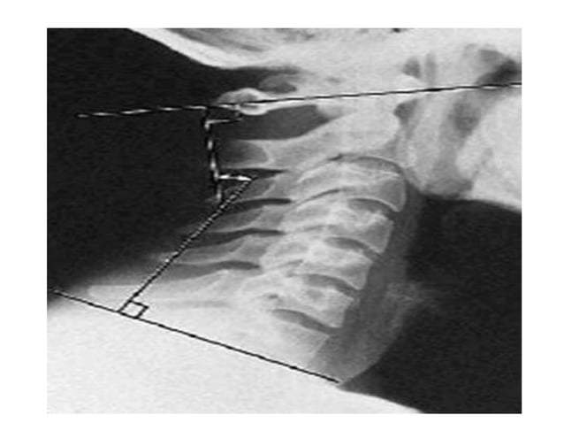 Radiographic lines and angles | PPTX