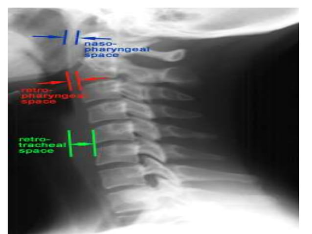Radiographic lines and angles | PPTX