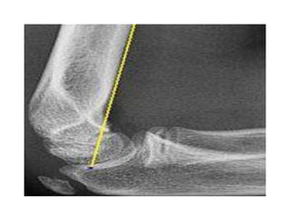 Radiographic lines and angles | PPTX