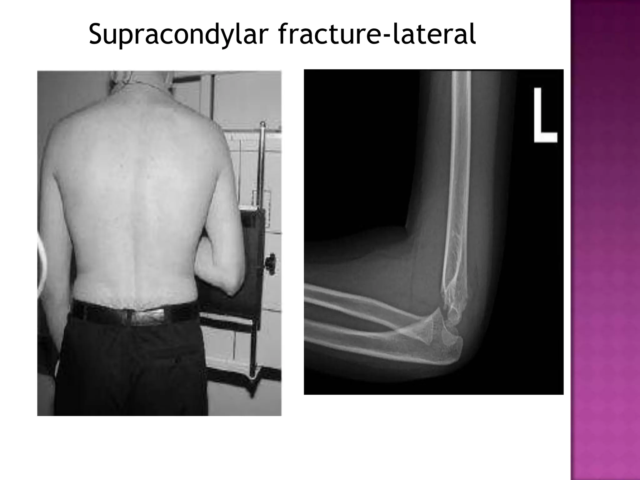 Radiographic positioning of humerus and shoulder | PPTX