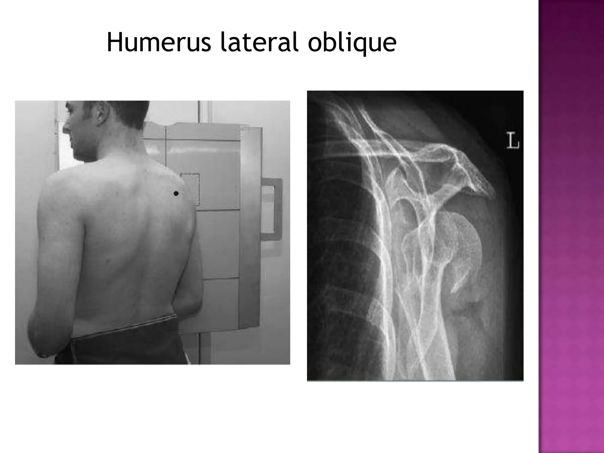 Radiographic positioning of humerus and shoulder | PPTX