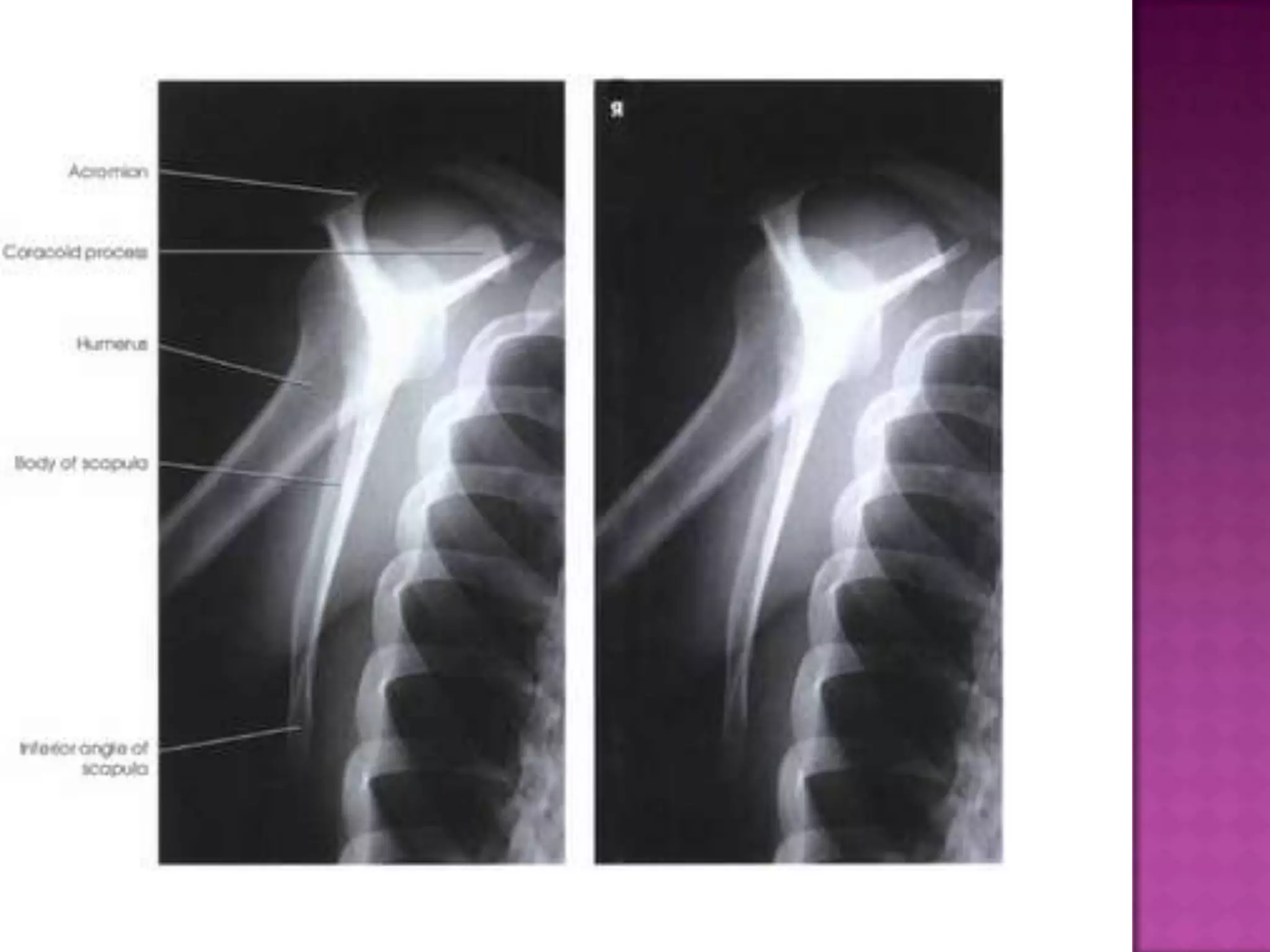 Radiographic positioning of humerus and shoulder | PPTX