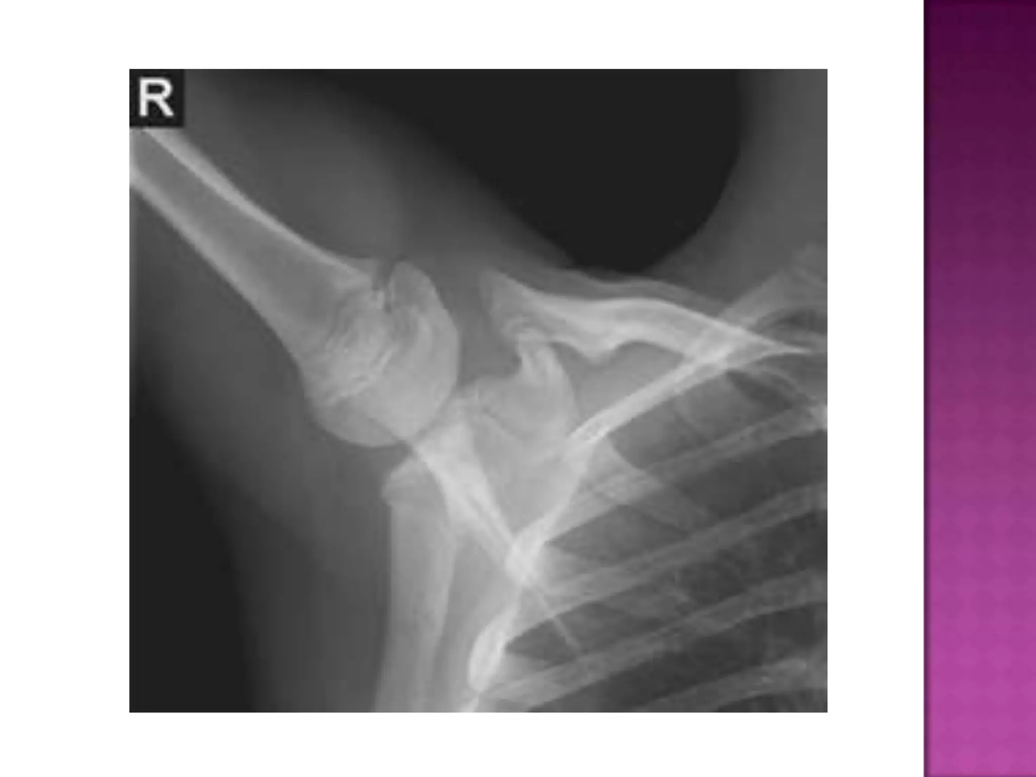 Radiographic positioning of humerus and shoulder | PPTX