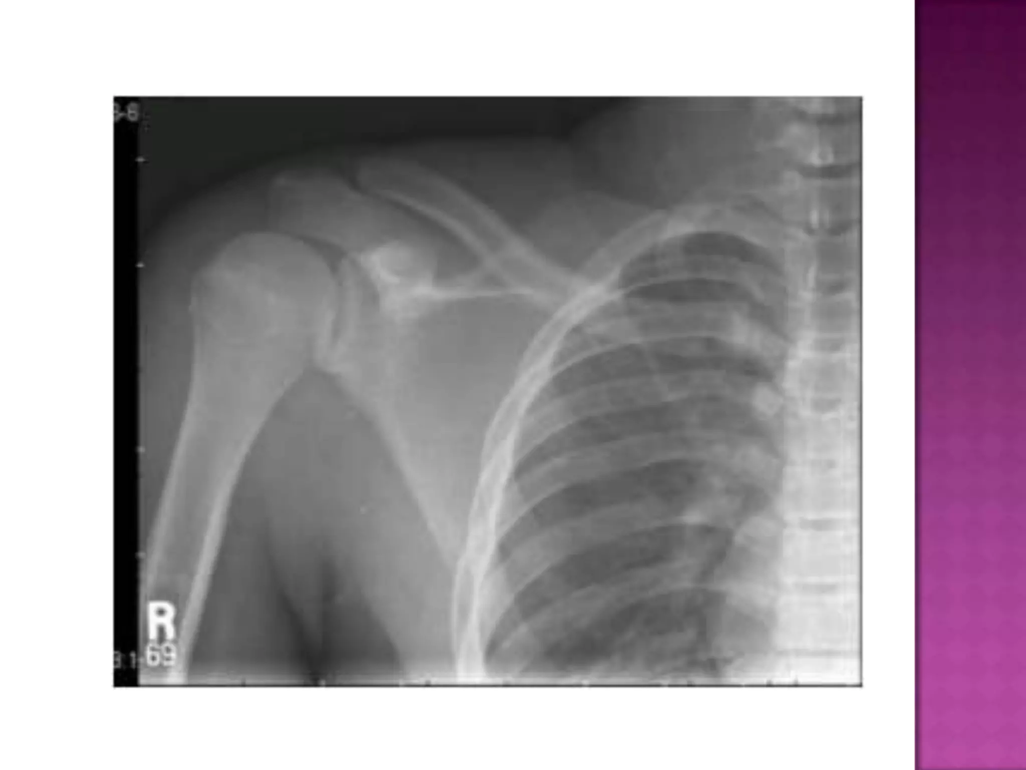 Radiographic positioning of humerus and shoulder | PPTX
