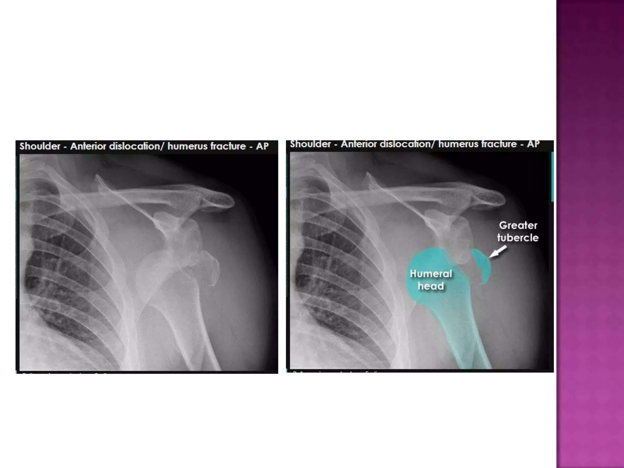 Radiographic positioning of humerus and shoulder | PPTX