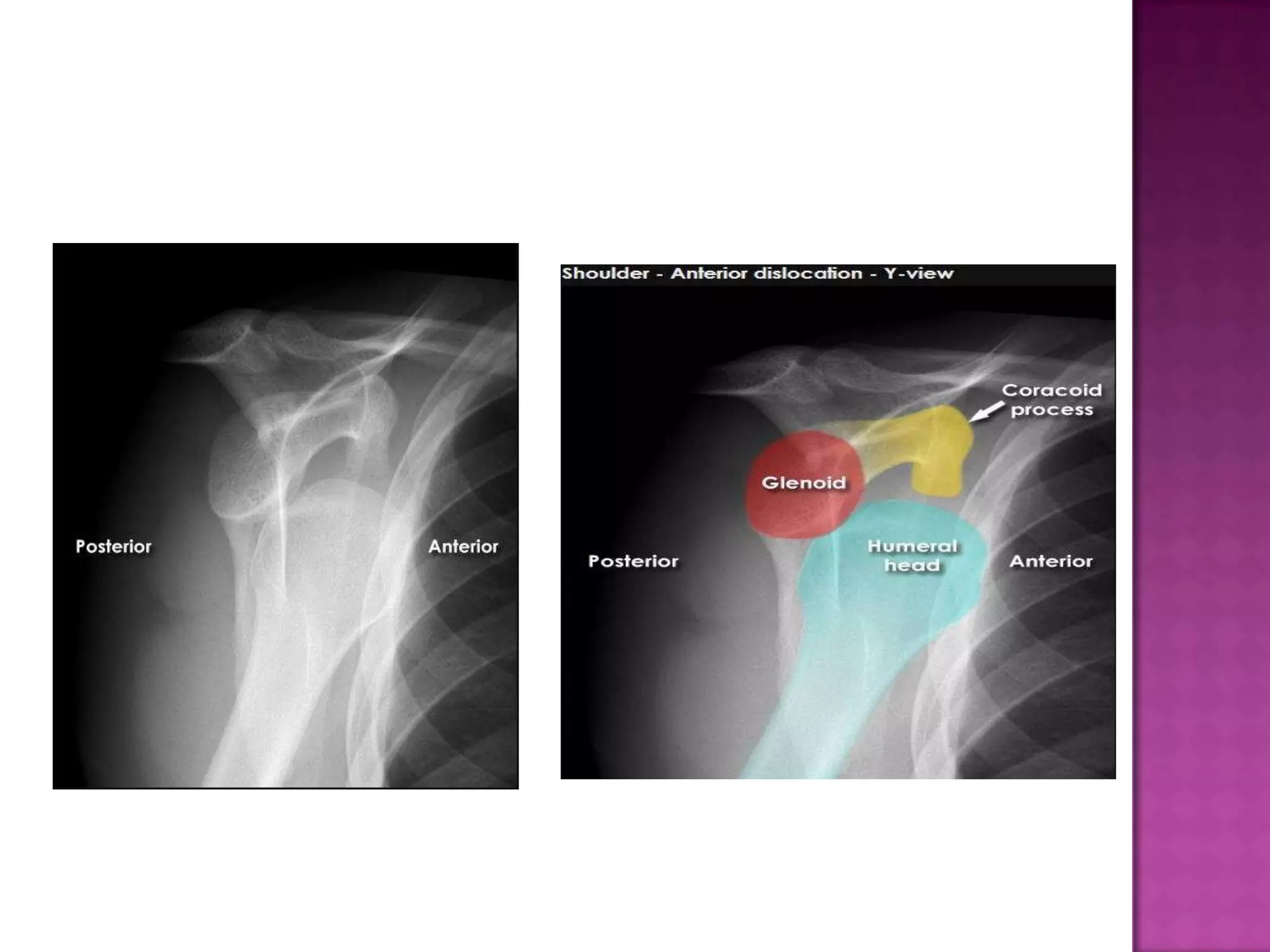 Radiographic positioning of humerus and shoulder | PPTX